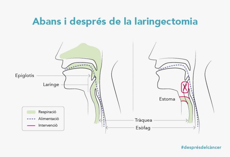 #comestic #laringe #faringe #laringectomia #traqueostoma #estoma #cura ...